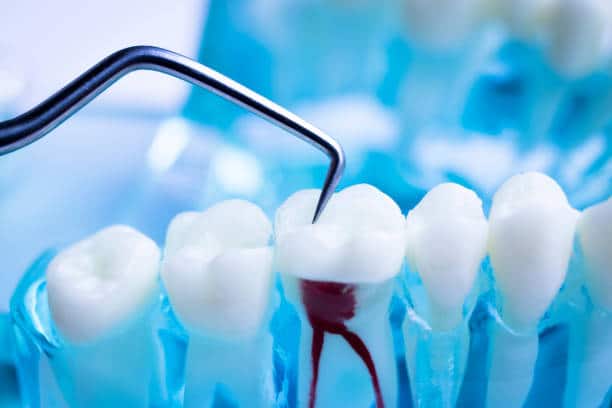 Root Canal : Expert Tips for a Smooth Healing Process